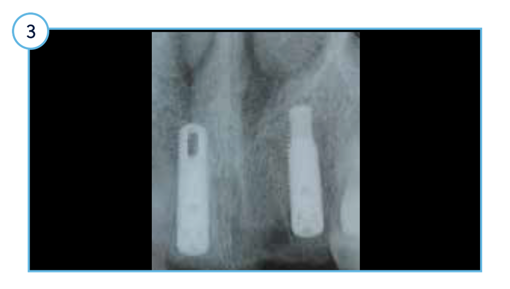 Tapered Screw-Vent® Implant | ZimVie Americas