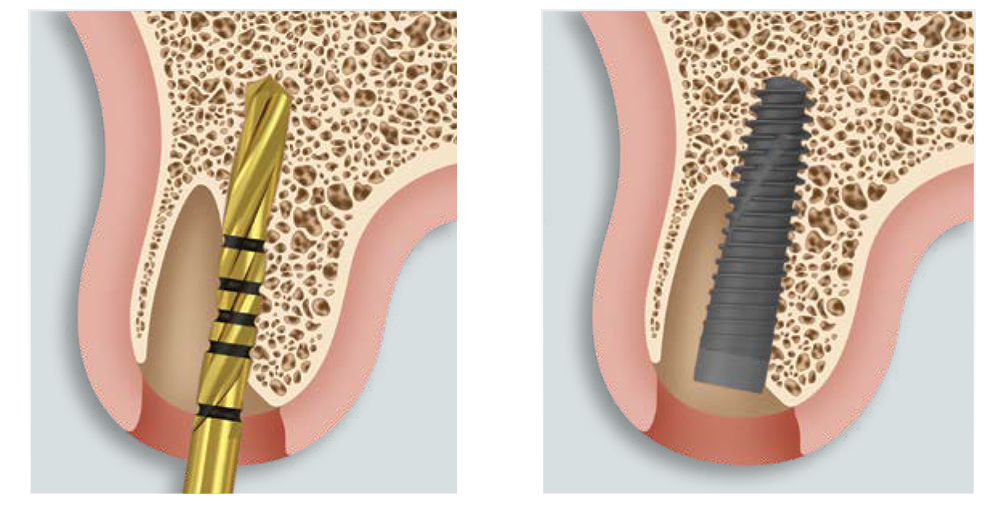 TSX™ Dental Implant